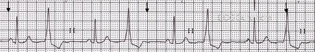 ECG BASICS: Sinus Rhythm With Ventricular Bigeminy | ECG Guru ... ECG BASICS: Sinus Rhythm With Ventricular Bigeminy | ECG Guru ...